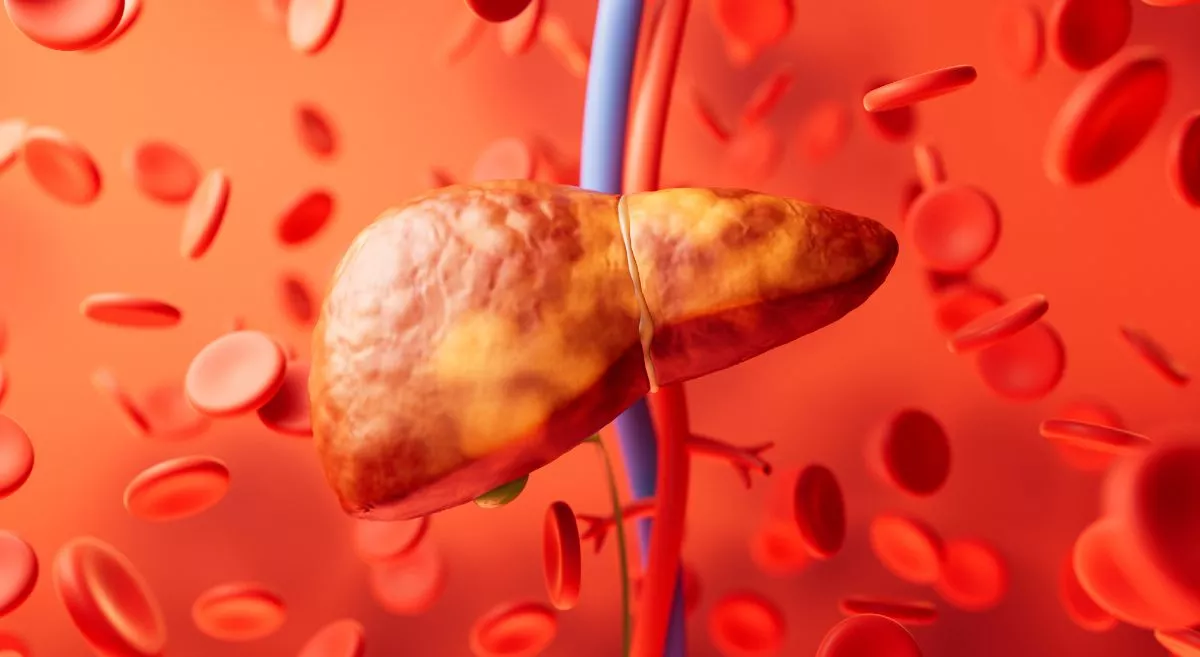 Managing Fatty Liver Disease with Expert Care at Aster CMI | Aster ... Managing Fatty Liver Disease with Expert Care at Aster CMI | Aster ...